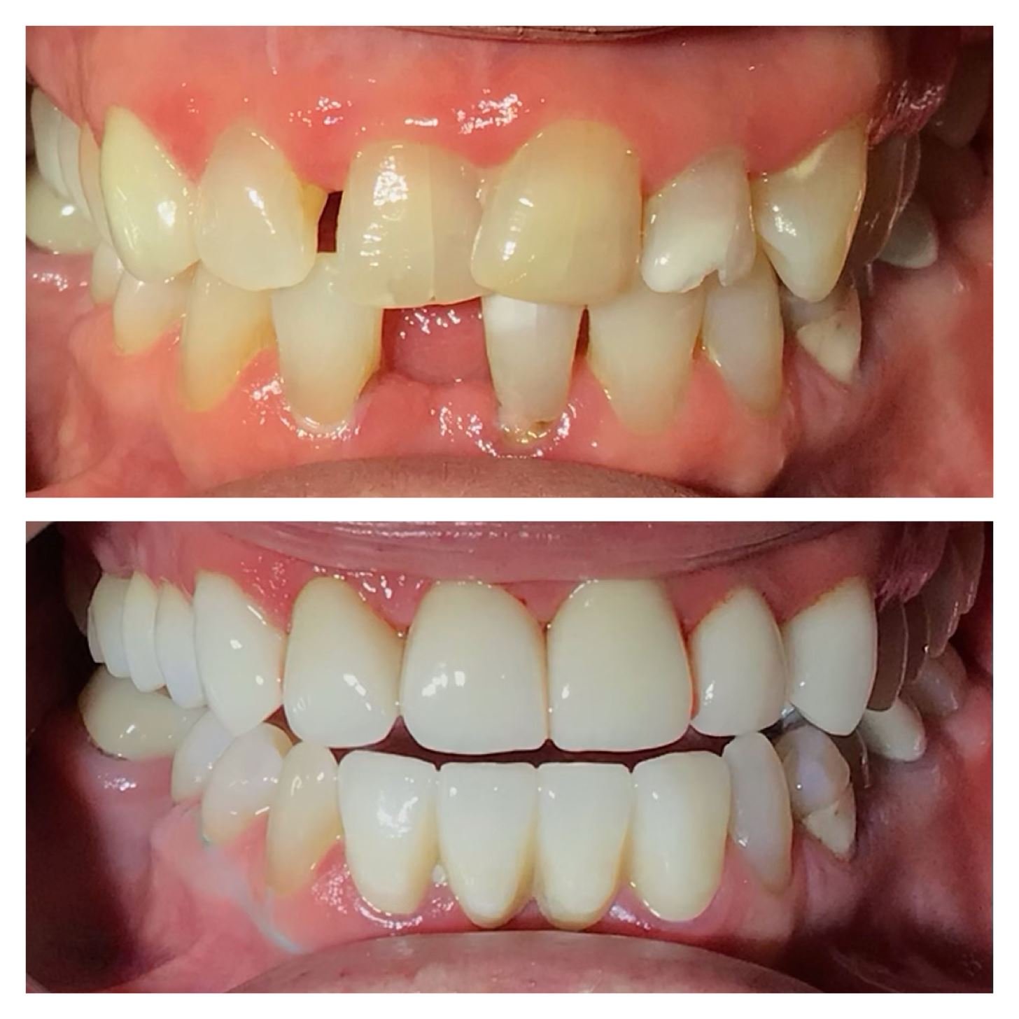 Multiple Crowns/Bridges | Vero Beach Dentist