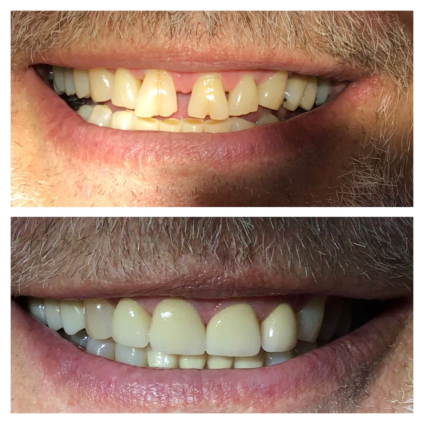 Multiple Crowns/Bridges | Vero Beach Dentist
