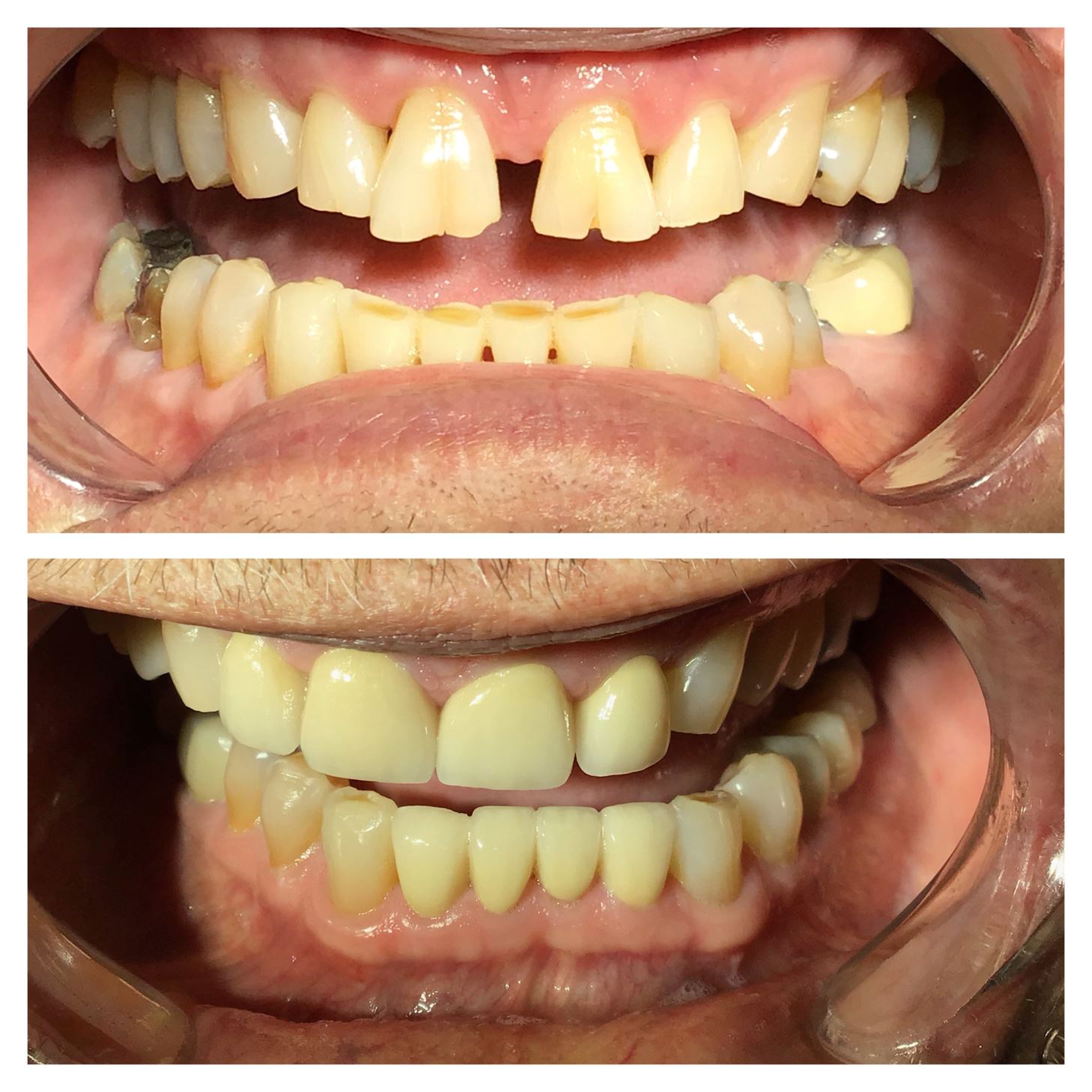 Treatment and Smile Gallery | Pelican Dental Care